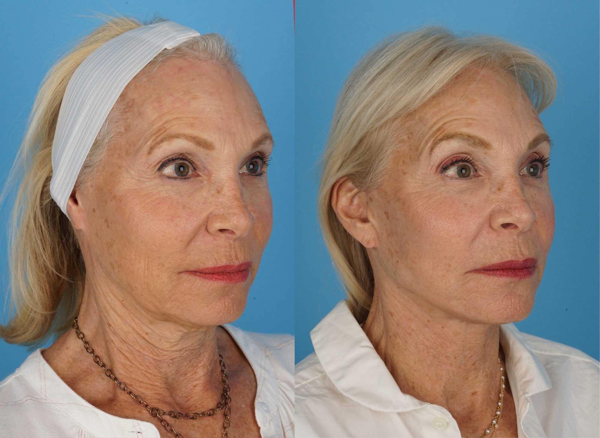 Before and After Photos | Jefferson Facial Plastics